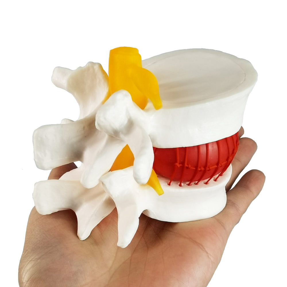 Evotech Scientific Human Lumbar Herniating Disc Demonstration Anatomy