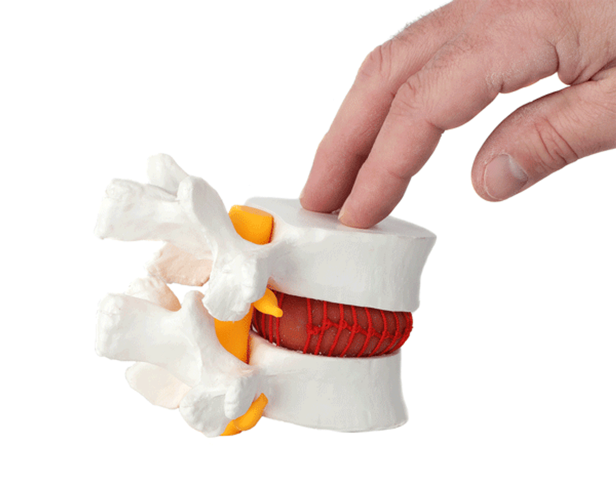 Evotech Scientific Human Lumbar Herniating Disc Demonstration Anatomy ...